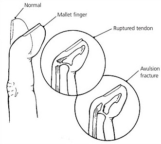 Mallet finger - GC Hand Therapy