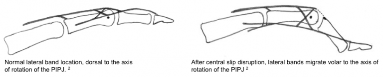 Management of Boutonniere Deformities - GC Hand Therapy