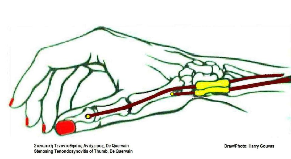Caring for your baby with De Quervain’s Tenosynovitis - GC Hand Therapy